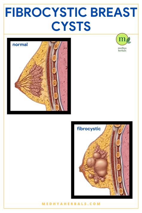 Breast Cysts Natural Treatment The Best Ayurvedic Remedies
