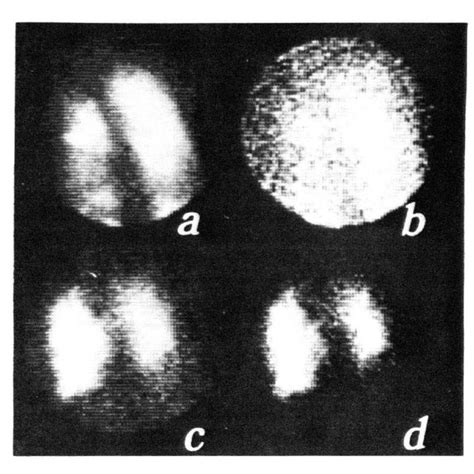 Rectilinear Thyroid Scan Demonstrates Hyperfunctioning Nodule In Upper Download Scientific