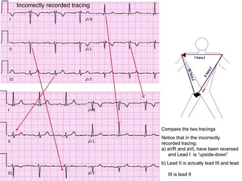 Lead Errors Reversal Of Limb Leads Ppt