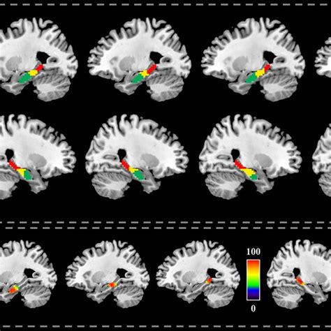 Group‐level And Individual Hippocampus Parcellation Results A Download Scientific Diagram