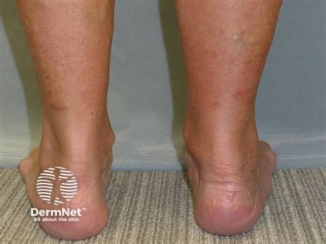 Exercise Induced Vasculitis