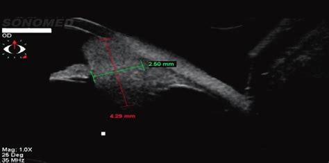 Ubm Showed A Solid Mass With Highmedium Reflectivity And Loss Of The
