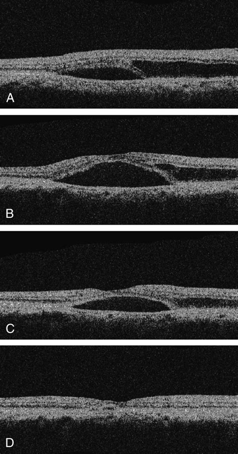 A Optical Coherence Tomography Demonstrating Intraretinal And Download Scientific Diagram