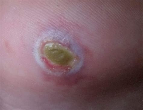 Diabetic Foot Ulcer Stage 2 3 Three Days After Using Santyl Does It