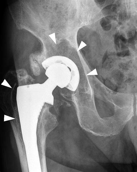 The Imaging Prevalence Of Osteolytic Metastasis Or Multiple Myeloma