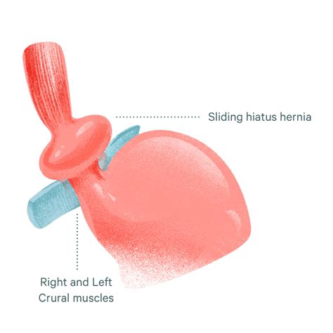Reflux Surgery Sydney Heartburn Treatment Dr Mark Magdy