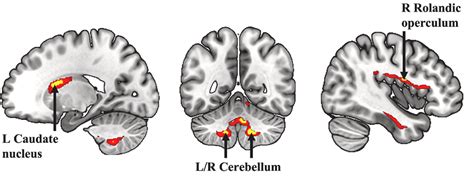 Operculum Brain Of The L