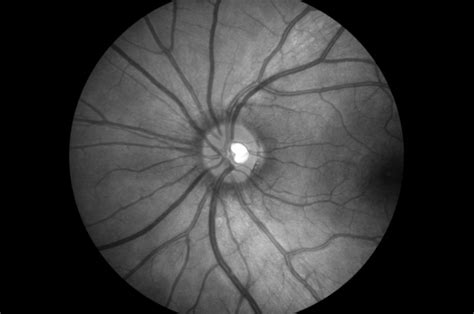 Imaging Retinal Pathologies Can Be Challenging With Current Technologies