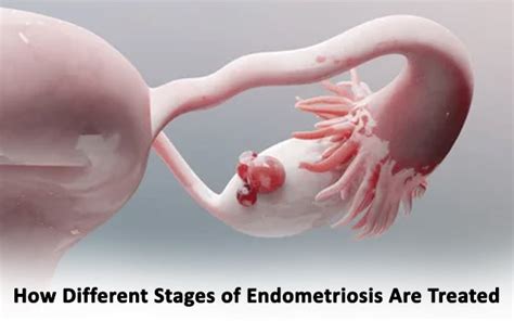 How Different Stages Of Endometriosis Are Treated