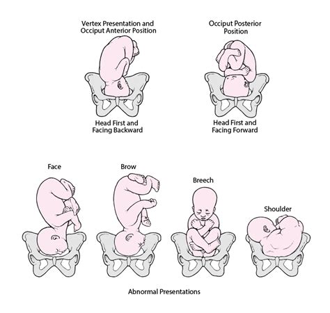 Fetal Presentation Position And Lie Including Breech Presentation