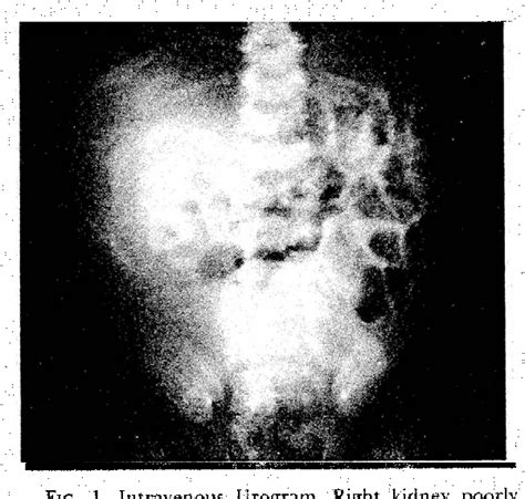 Figure 1 From Urinary Extravasation During High Dose Semantic Scholar