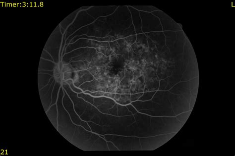 Multifocal Pattern Dystrophy