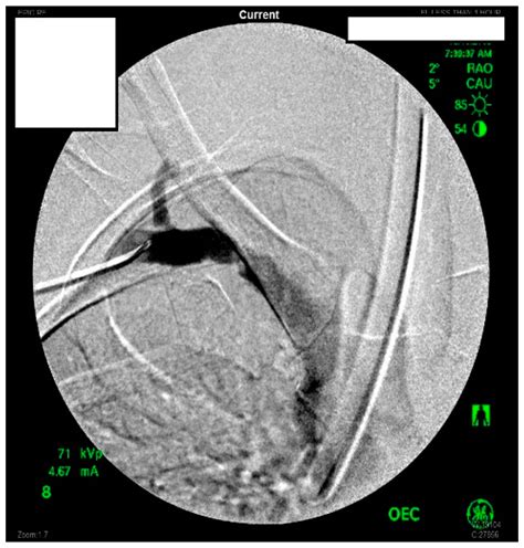 Cpt Ct Venogram