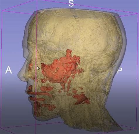 How Much Filler Did Alice Hart Davis Mri Reveal The British Beauty