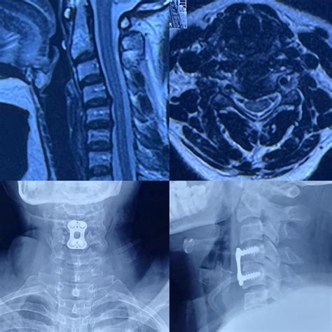 Dr Latif Khan Fcps Orth On Linkedin Spine Cervicalspine Discherniation Acdf
