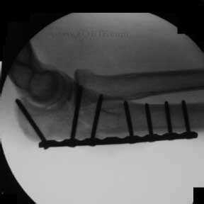 Olecranon Fracture ORIF 24685 EORIF