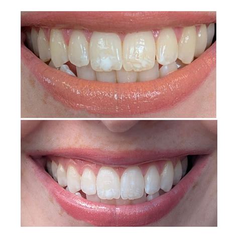 Fluorosis Teeth Dental Fluorosis Treatment