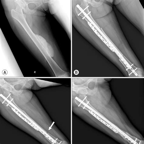 A B This Patient Underwent Intercalary Resection And Reconstruction Download Scientific