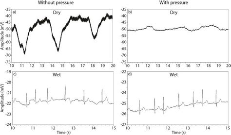 Ecg Signals With The Person Seated Derivation Ll Ra Download Scientific Diagram