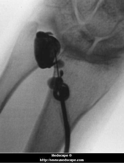 Imaging Of The Wrist And Hand Page 5