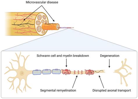Pathogenesis Of Distal Symmetrical Polyneuropathy In Diabetes Pmc