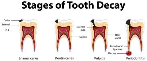 Tooth Decay Process