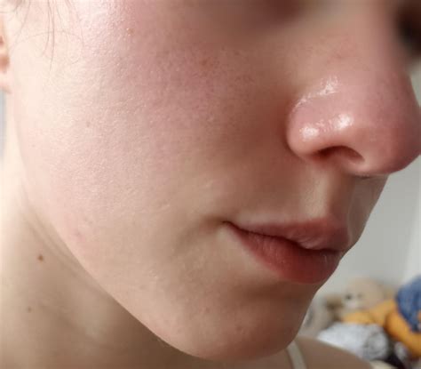 Skin Inflammation And Follicular Macular Atrophy Worsening Nosolabial Folds At 22 What Do I