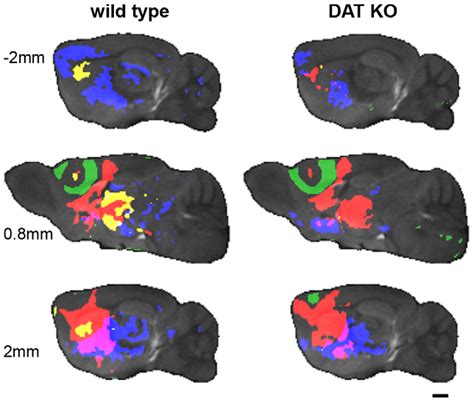 Sagittal Sections Of Statistical Parametric Maps Show The Progression