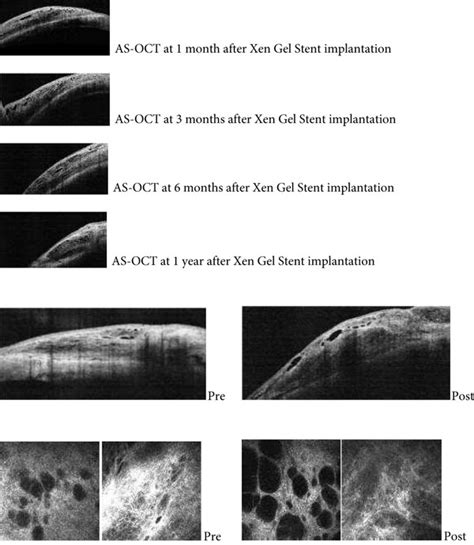 Pre And Postoperative As Oct Scans Download Scientific Diagram