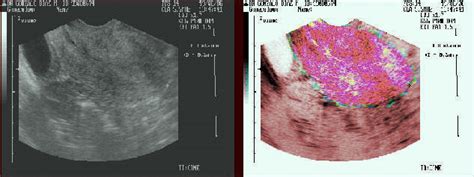 Ultrasound Image Uterus Adenomyosis