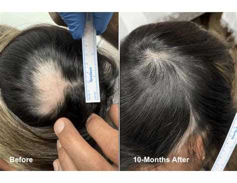 Womens Before And After Prp Hair Restoration Naples And Fort Myers Fl