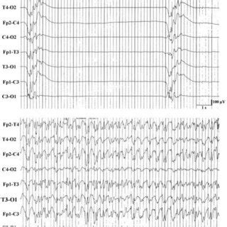 Transitional EEG Pattern Between Burst Suppression EEG And Continuous Download Scientific