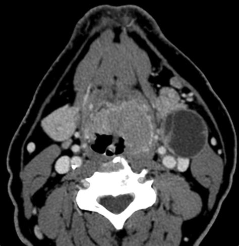 Base Of Tongue Cancer Hpv