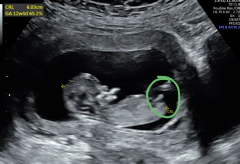 12 Week Ultrasound Gender Boy