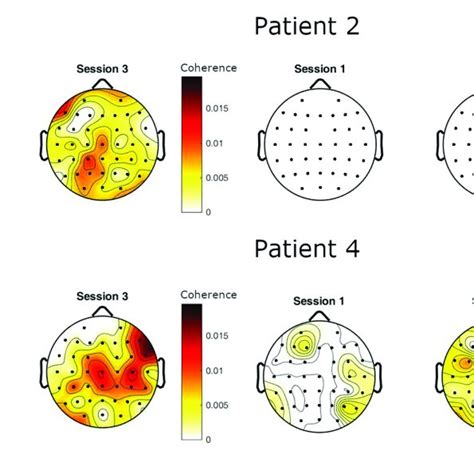 Eeg Emg Coherence In The Beta Frequency Range In Four Patients Download Scientific Diagram