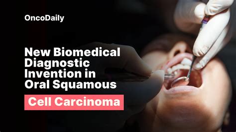 Read News And Stories About Oral Squamous Cell Carcinoma Oscc Oncodaily