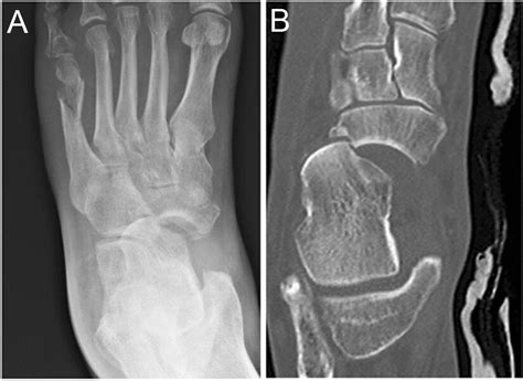 Chopart Tnj Fracture Dislocation Example Anteroposterior Radiograph Download Scientific
