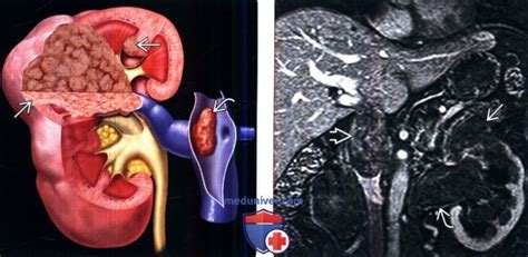 КТ МРТ УЗИ при почечноклеточном раке