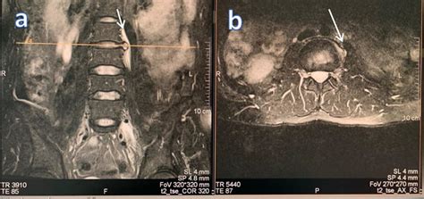 T2 Turbo Spin Echo With Fat Saturation Scan In The Sagittal And Axial