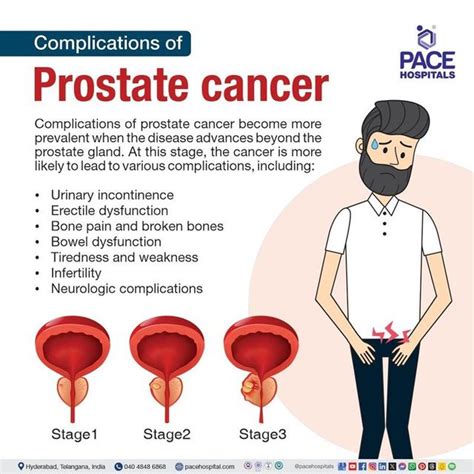 Prostate Cancer Symptoms And Signs Prostate Cancer Symptoms How Are