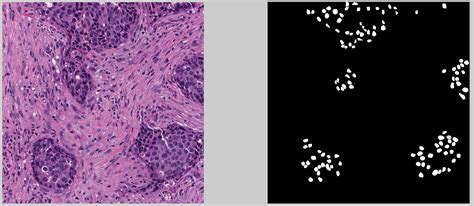 Use Case Nuclei Segmentation Andrew Janowczyk
