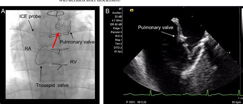 Figure 1 From Visibility Of Pulmonary Valve And Pulmonary Regurgitation