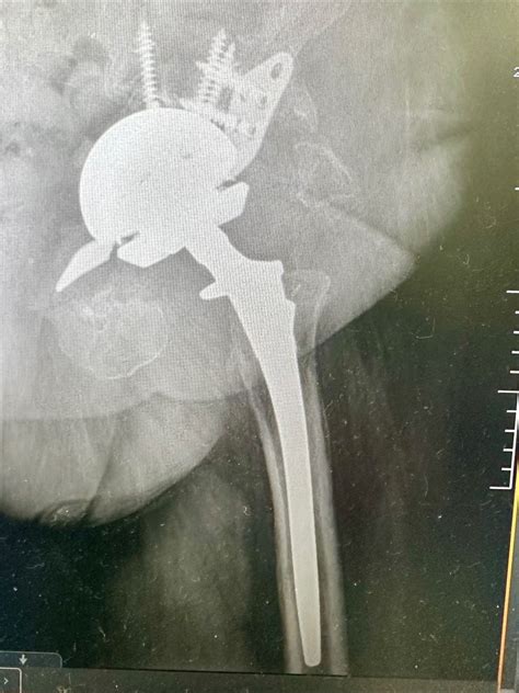 Watson Extraction System On Linkedin Hiprevision Orthopedicsurgery Orthopedicsurgeon