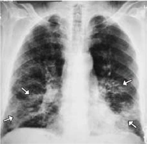 Chest X Ray Showing Concomitant Bilateral Reticular Interstitial