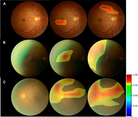 Frontiers Artificial Intelligence Model For Antiinterference Cataract Automatic Diagnosis A