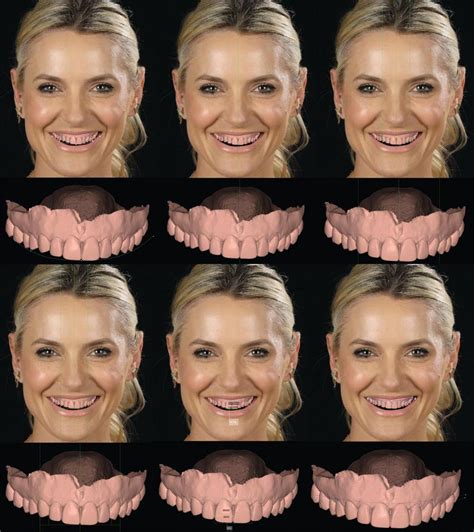 Digital Workflow In Prosthodontics Restorative Dentistry Pocket Dentistry