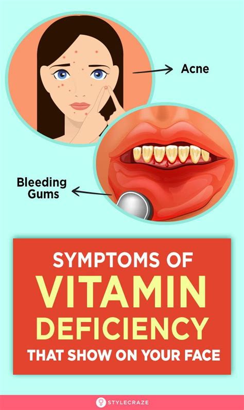 6 Symptoms Of Vitamin Deficiency That Show On Your Face Vitamins Help