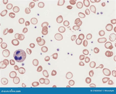 Iron Deficiency Anemia Stock Image Image Of Iron Peripheral 278205567