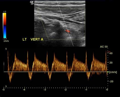 Subclavian Steal Syndrome Pacs