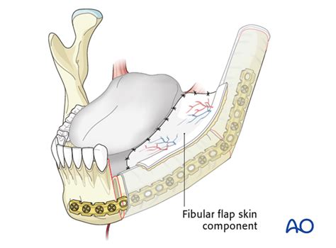 Plate And Fibular Osteocutaneous Free Flap For Lateral Mandible